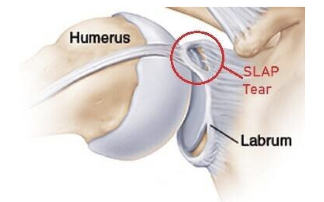 Shoulder Labral Tears Ohio Healthcare Partners Akron OH Shoulder Labral Tears Ohio Healthcare Partners Akron OH